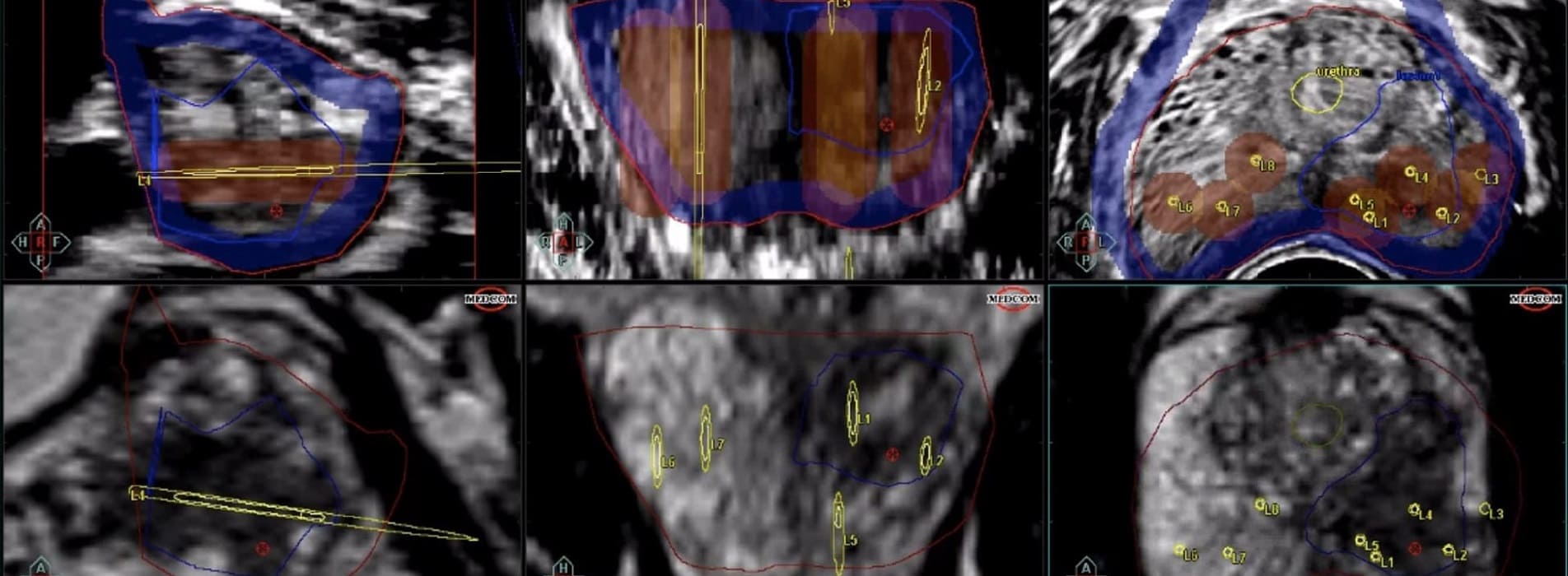 Prostatakrebs? Diagnose bei Prof. Dr. med. Seitz aus München